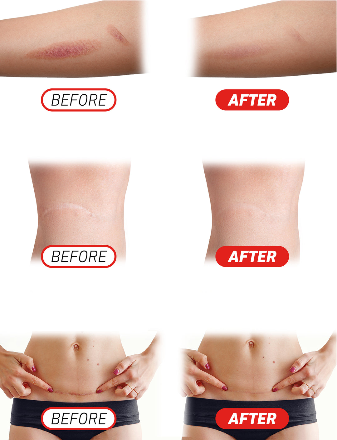 Silicone for scar healing store